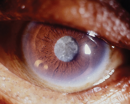 Slide-02 – Fillmore Eye Clinic